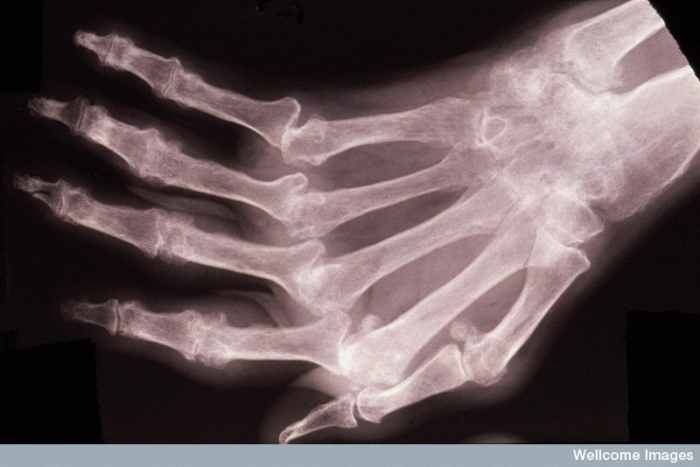 Could Your Pain Be Caused by Eating Nightshade Vegetables ...