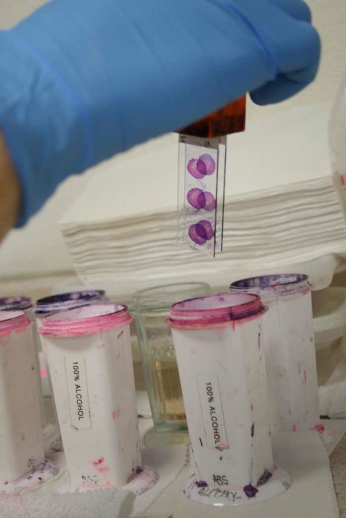 Using the Frozen Section Procedure to Diagnose Carcinoma - HealthProAdvice