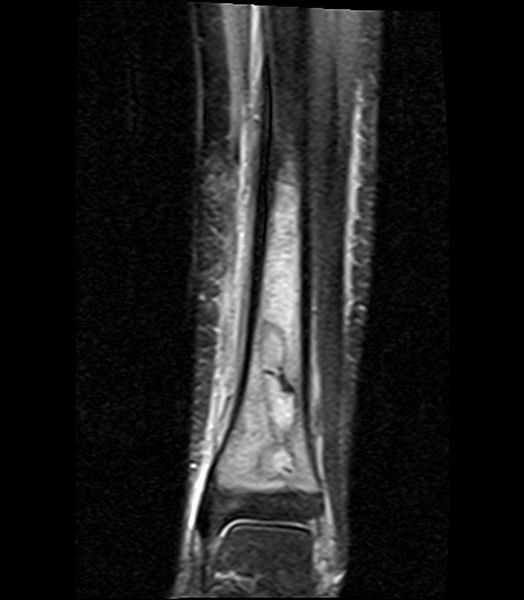 Infections (Other Than HIV) That IV Drug Users Contract: Hepatitis ...