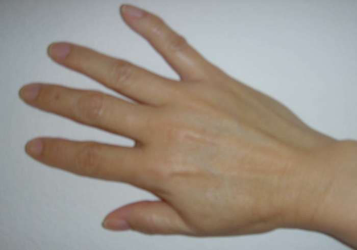 Alexandrite Laser for Treatment of Sun-Damaged Skin - HubPages