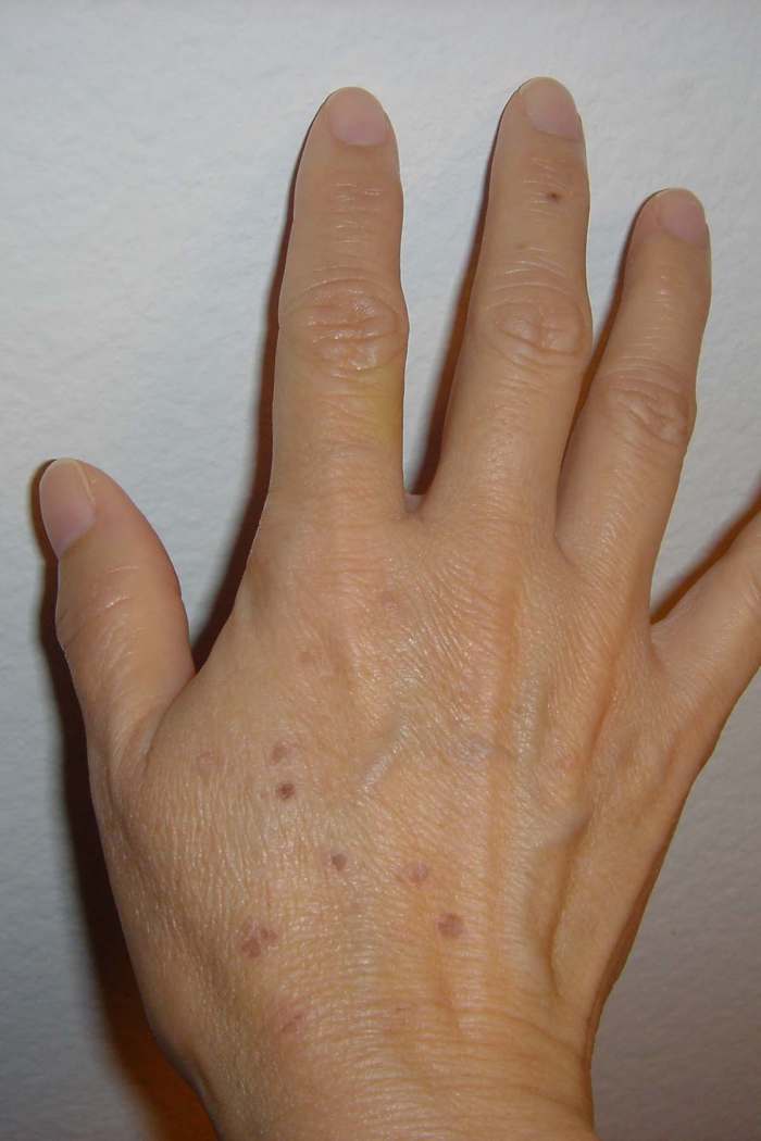 Alexandrite Laser for Treatment of Sun-Damaged Skin - HubPages