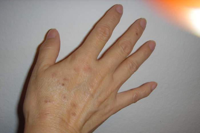 Alexandrite Laser for Treatment of Sun-Damaged Skin - HubPages