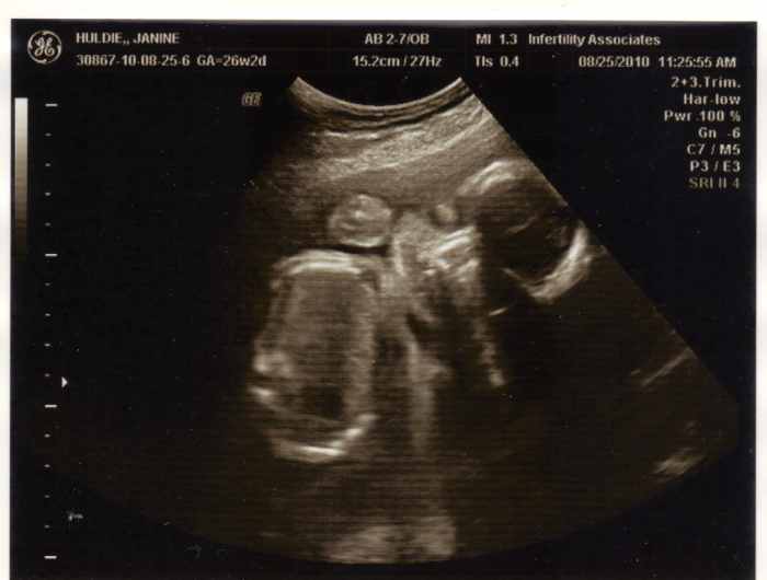 Different Types of Sonograms During Pregnancy - WeHaveKids