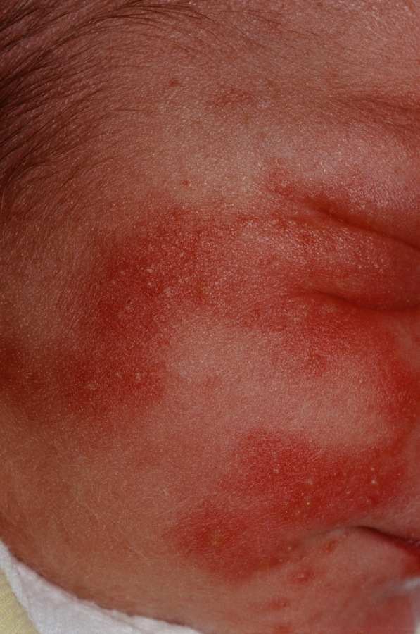 Is It a Rash or Baby Acne? - WeHaveKids