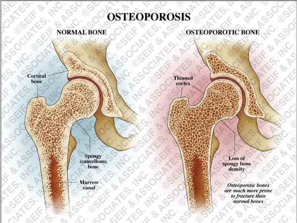 The Process of Bone Resorption Explained - Owlcation