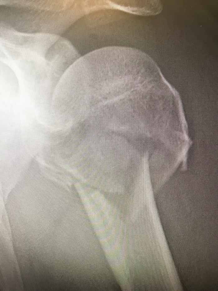 Recovering From a Broken Humerus Head - Patient's Lounge
