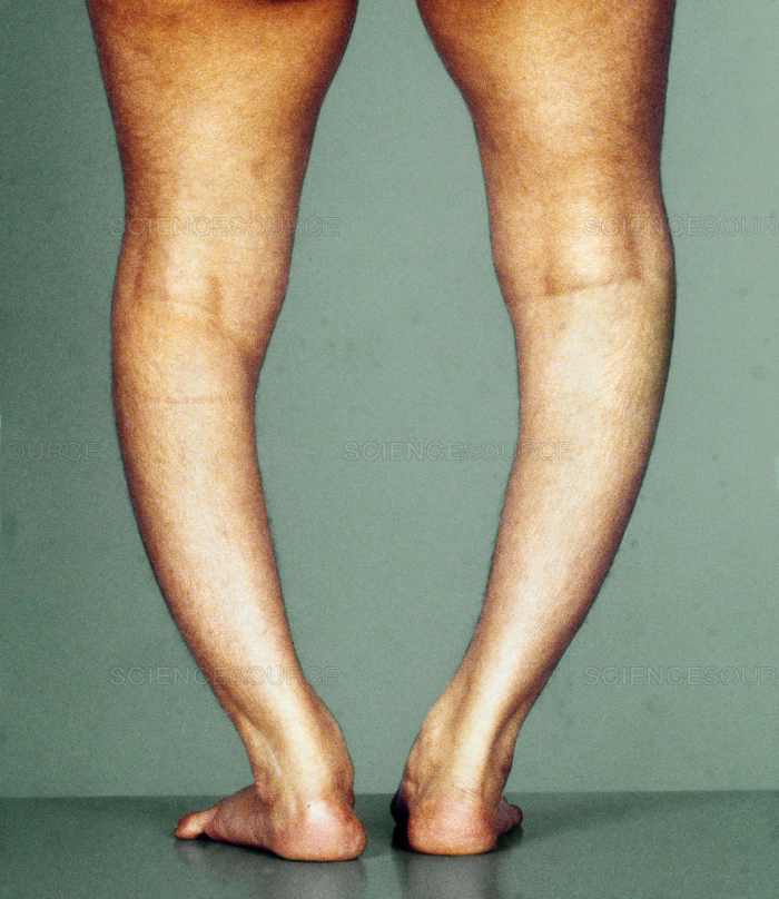 Why Are People Vitamin D Deficient - HubPages