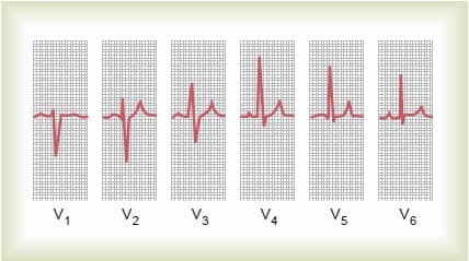 How to read a normal ECG(Electrocardiogram)? - HubPages