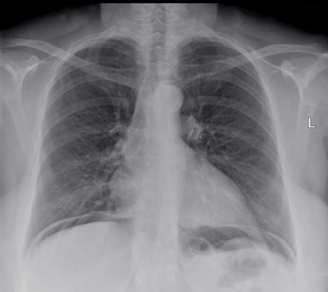 Symptoms, Causes, Treatment, and Complications of Pneumoperitoneum ...