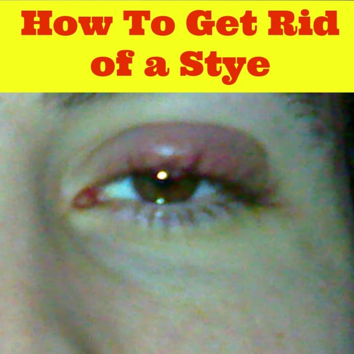 How to Get Rid of a Stye in Your Eye - Eye Stye Treatment - HubPages