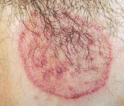 Dermatophytes that causes Cutaneous mycoses in humans and How to deal ...