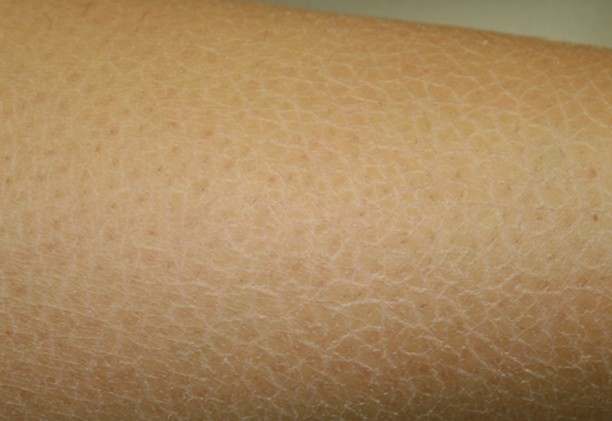 Xerosis - Definition, Pictures, Treatment, Symptoms and Causes - HubPages