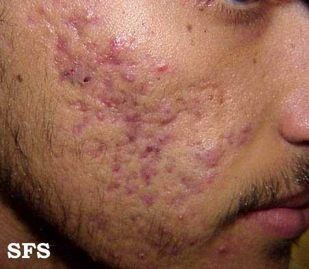 Skin Staph Infections with Pictures - HubPages