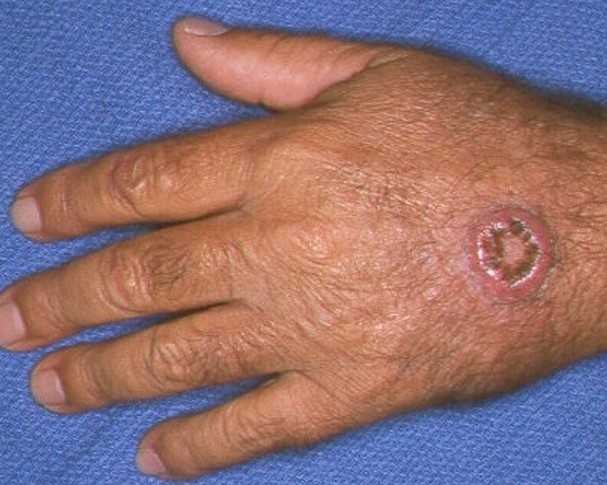 Keratoacanthoma - Pictures, Symptoms, Treatment, Causes, Diagnosis ...