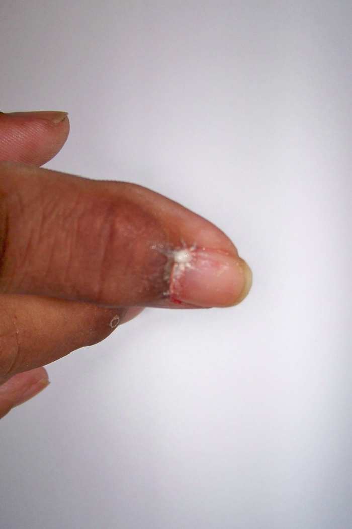 Acute gouty arthritis (Gout) and Kidney cancer surgery complications ...