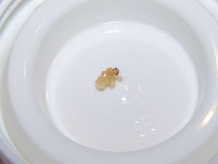 How to Recognize Early Symptoms of Kidney Stones: My Story - Patient's ...