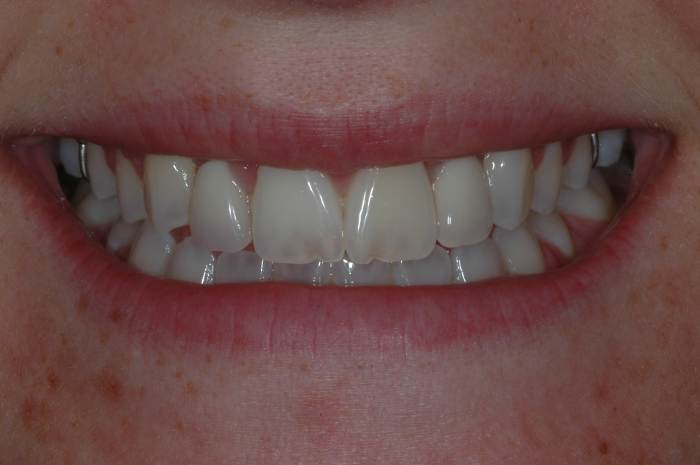 What's the best way to replace a missing tooth or teeth? - HubPages