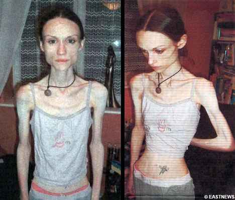 Eating Disorders: Anorexia and Bulimia - HubPages