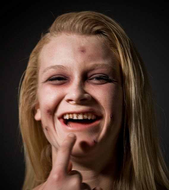 Meth Mouth and Dental Health; If You Have Meth Mouth You Should Seek ...