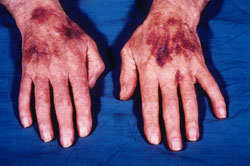 Causes of Senile Purpura - Information and Symptoms of Senile Bleeding ...