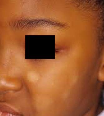 Pityriasis Alba - Pictures, Causes, Symptoms, Treatment - HubPages