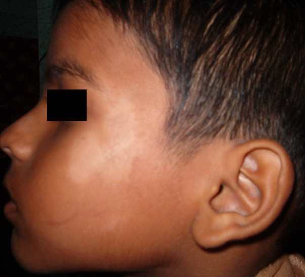 Pityriasis Alba - Pictures, Causes, Symptoms, Treatment - HubPages