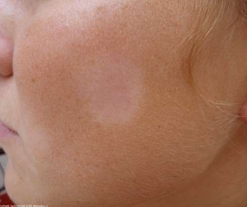 Pityriasis Alba - Pictures, Causes, Symptoms, Treatment - HubPages