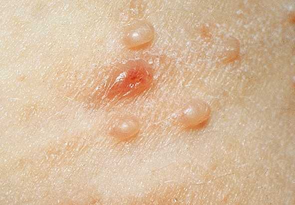 Molluscum Contagiosum - Pictures, Symptoms, Treatment, Causes - HubPages