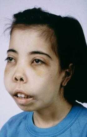 Thalassemia is a preventable disease - HubPages