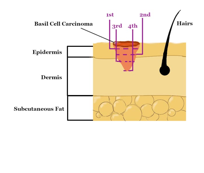 Basal Cell Carcinoma - HubPages