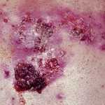 What Is Acne? How Can I Get Rid Of It? And What Kind Of Acne Do I Have ...