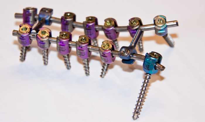 Three C-Fusions,after Surgery and Removal of Associated Hardware ...