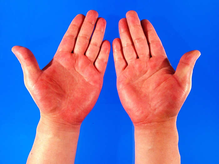 What Your Hands Can Tell You About Your Health - HubPages