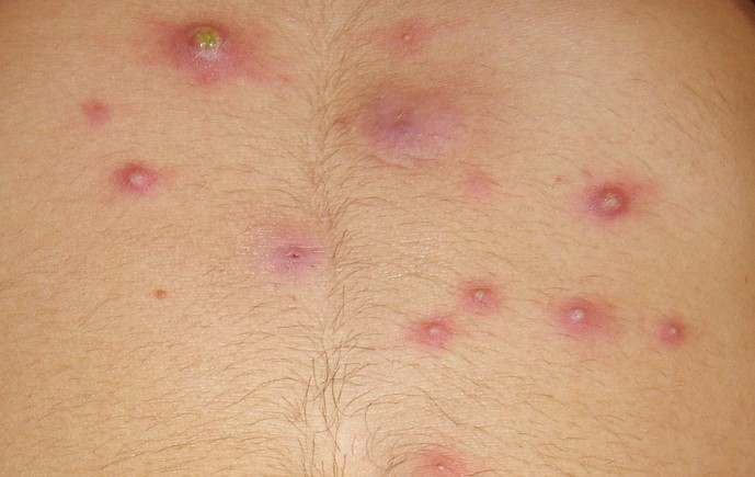 Furunculosis - Pictures, Causes, Symptoms, Treatment - HubPages