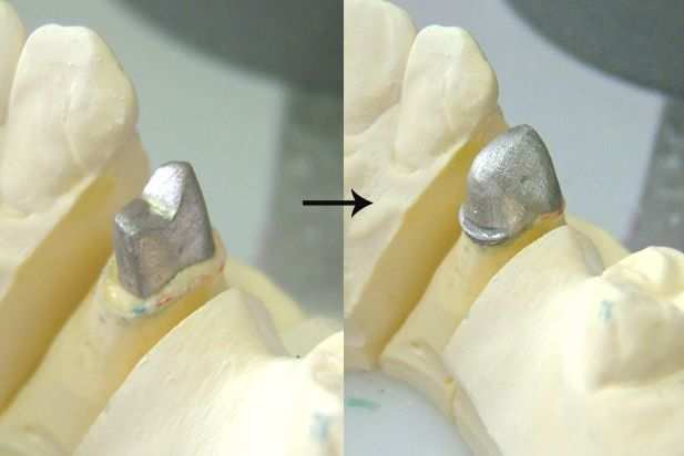 How Dental PFM Crowns are Made | Step-by-Step Photos ★ - HubPages