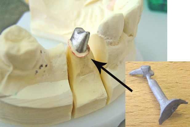 How Dental PFM Crowns are Made | Step-by-Step Photos ★ - HubPages