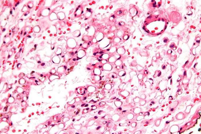 Liposuction and Its Long-Term Effects - HubPages