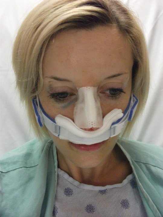 My Septoplasty Surgery Experience and the Road to Recovery - Patient's ...
