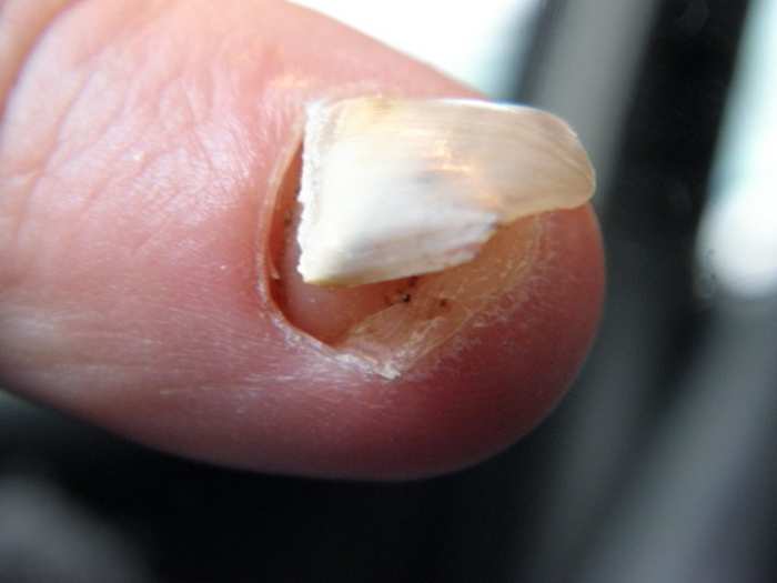 Nail Diseases, Disorders, and Conditions: Listen to What Your Nails ...