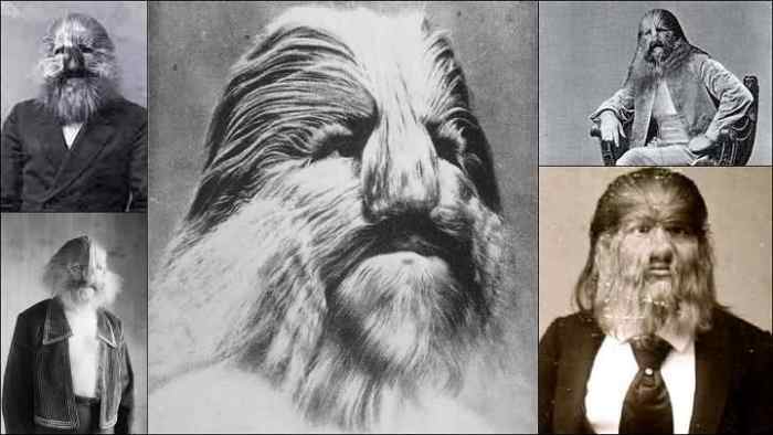 Freaks, Human Oddities, Freak Shows and Side Shows: Part I - Famous ...