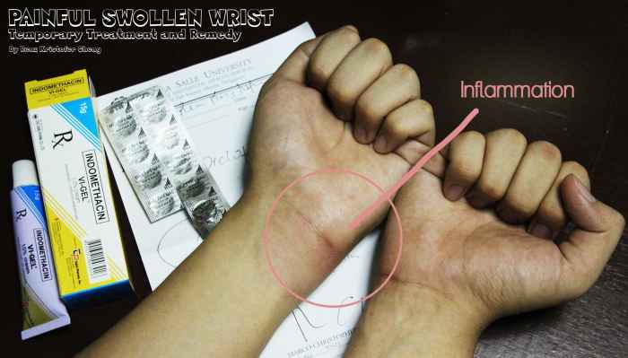Home Remedy and Treatment for Painful Swollen Wrist - Medicines and ...