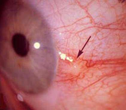 Symptoms, Causes, and Treatment of Pinguecula - HubPages