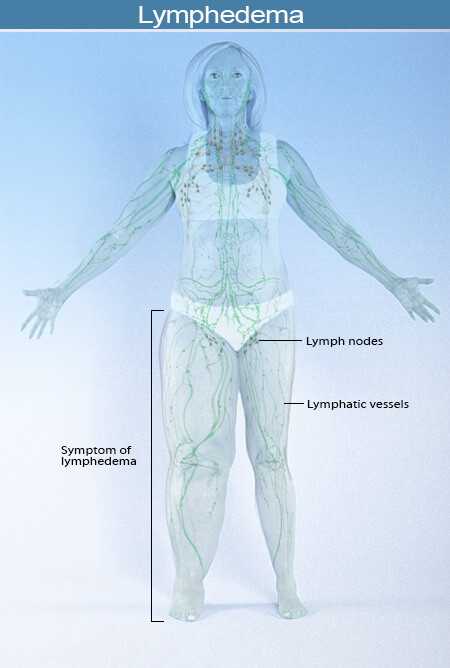 Lymphedema: What It Is and How to Treat It - HubPages