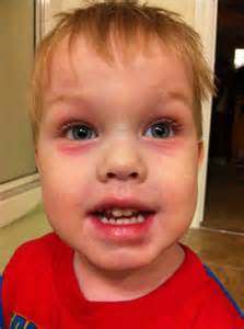 Allergy Shiners How To Cure Them... - HubPages