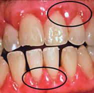 Causes of Gum Blisters and Home Remedies for Treatment - HubPages
