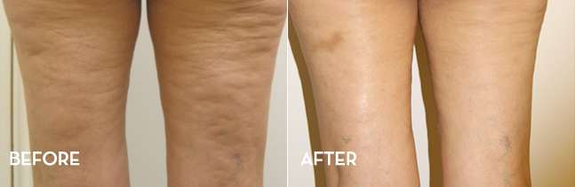 12 Easy Ways to Get Rid of Cellulite From Thighs, Buttocks, Hips, and ...