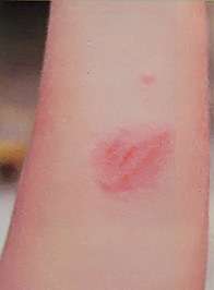 How to Recognize and Prevent Poison Ivy/Oak/Summac Rash and Irritations ...