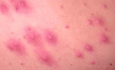 Folliculitis – Pictures, Symptoms, Causes, Treatment - HubPages
