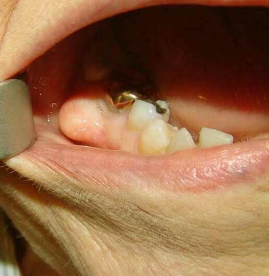 Exostosis - of Foot, Mouth, Ear, Definition, Pictures - HubPages