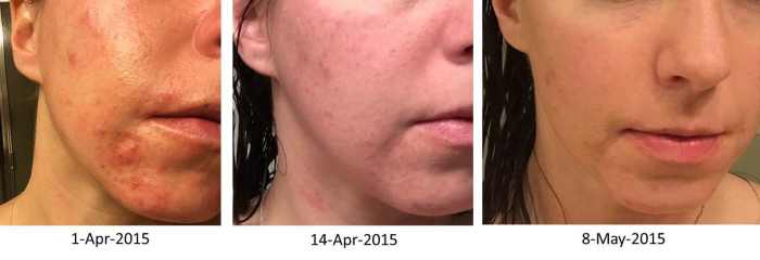 How I Cured My Seborrheic Dermatitis Acne - HubPages